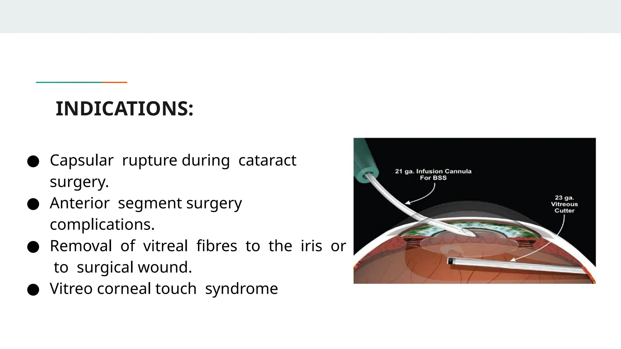 VITREOUS LOSS secondary to cataract surgery | PPTX