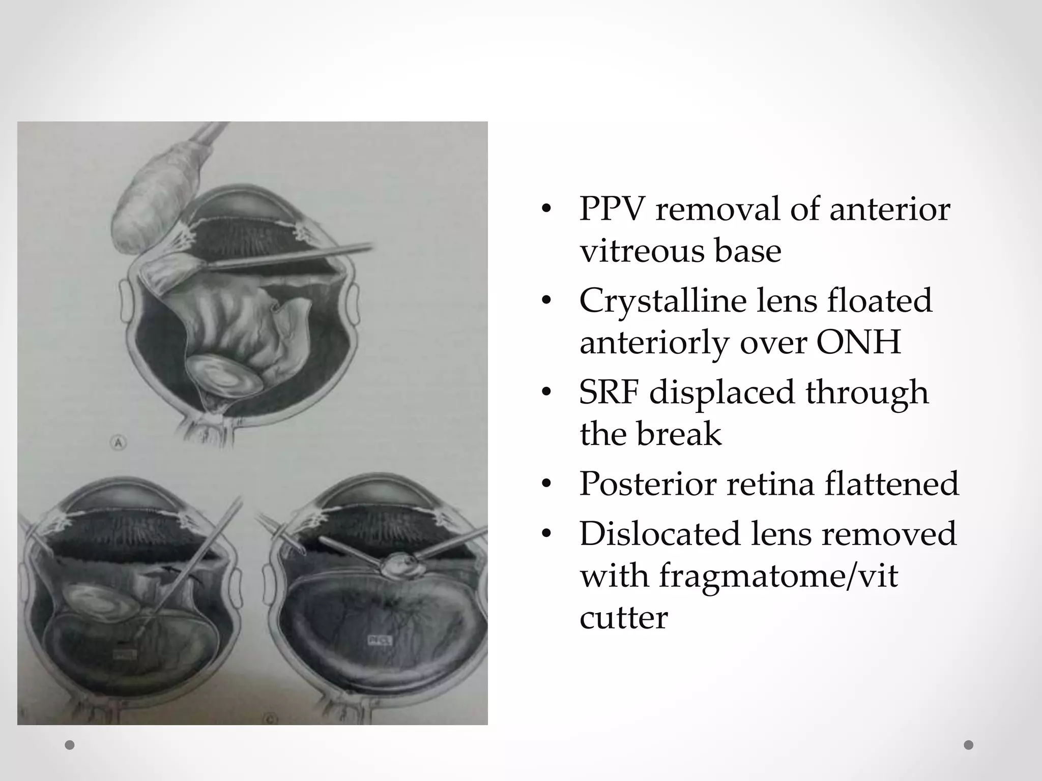Vitreous substitutes | PPTX