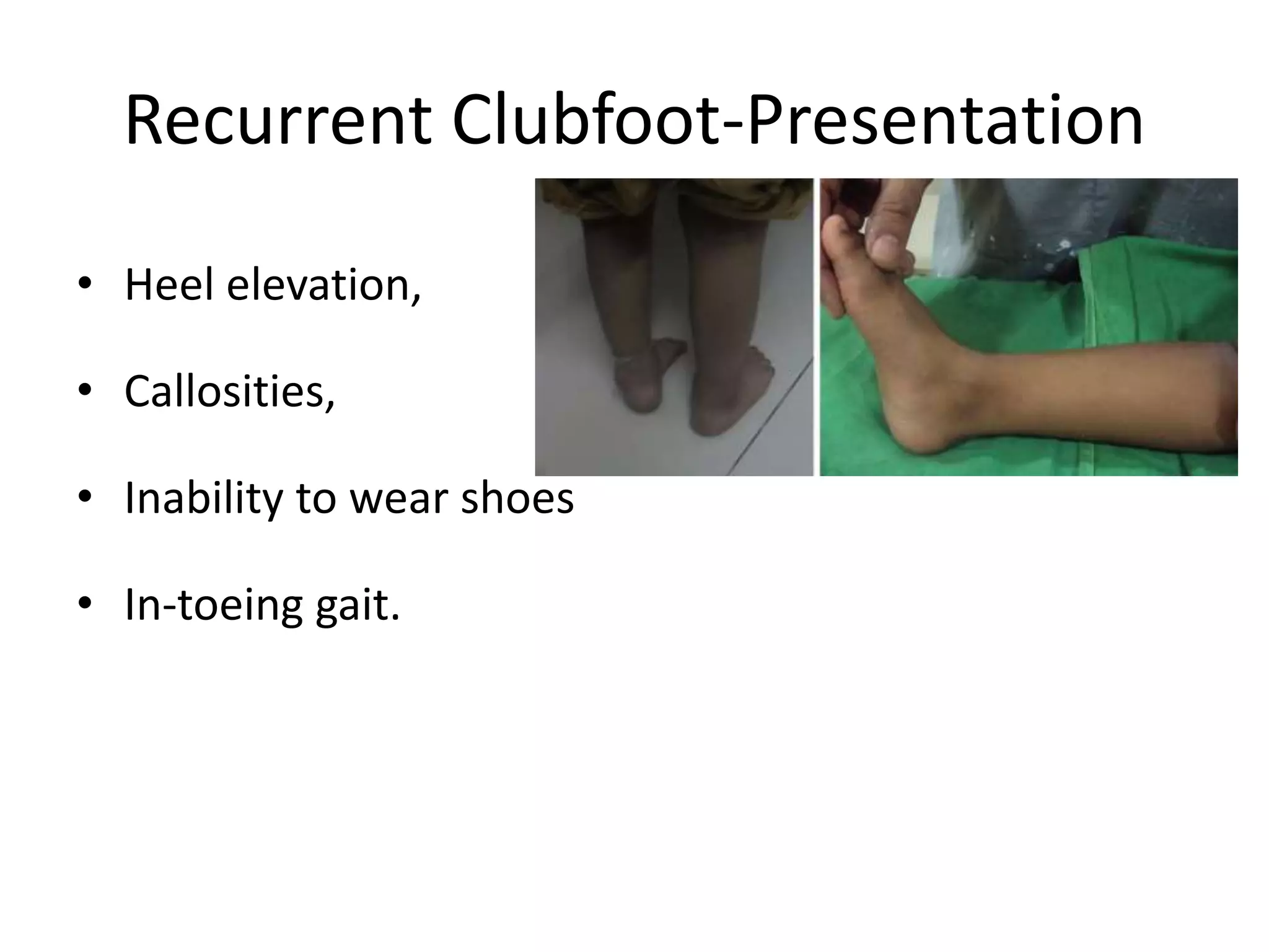 Recurrent clubfoot CTEV | PPTX