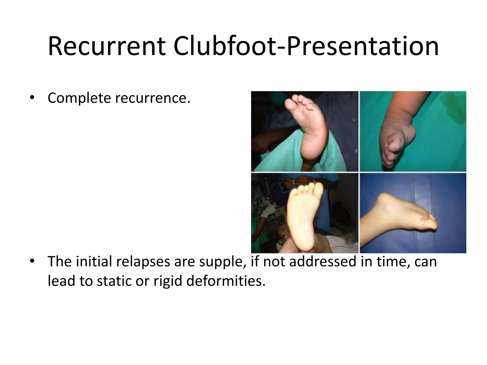 Recurrent clubfoot CTEV | PPTX