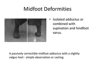 Recurrent clubfoot CTEV | PPTX