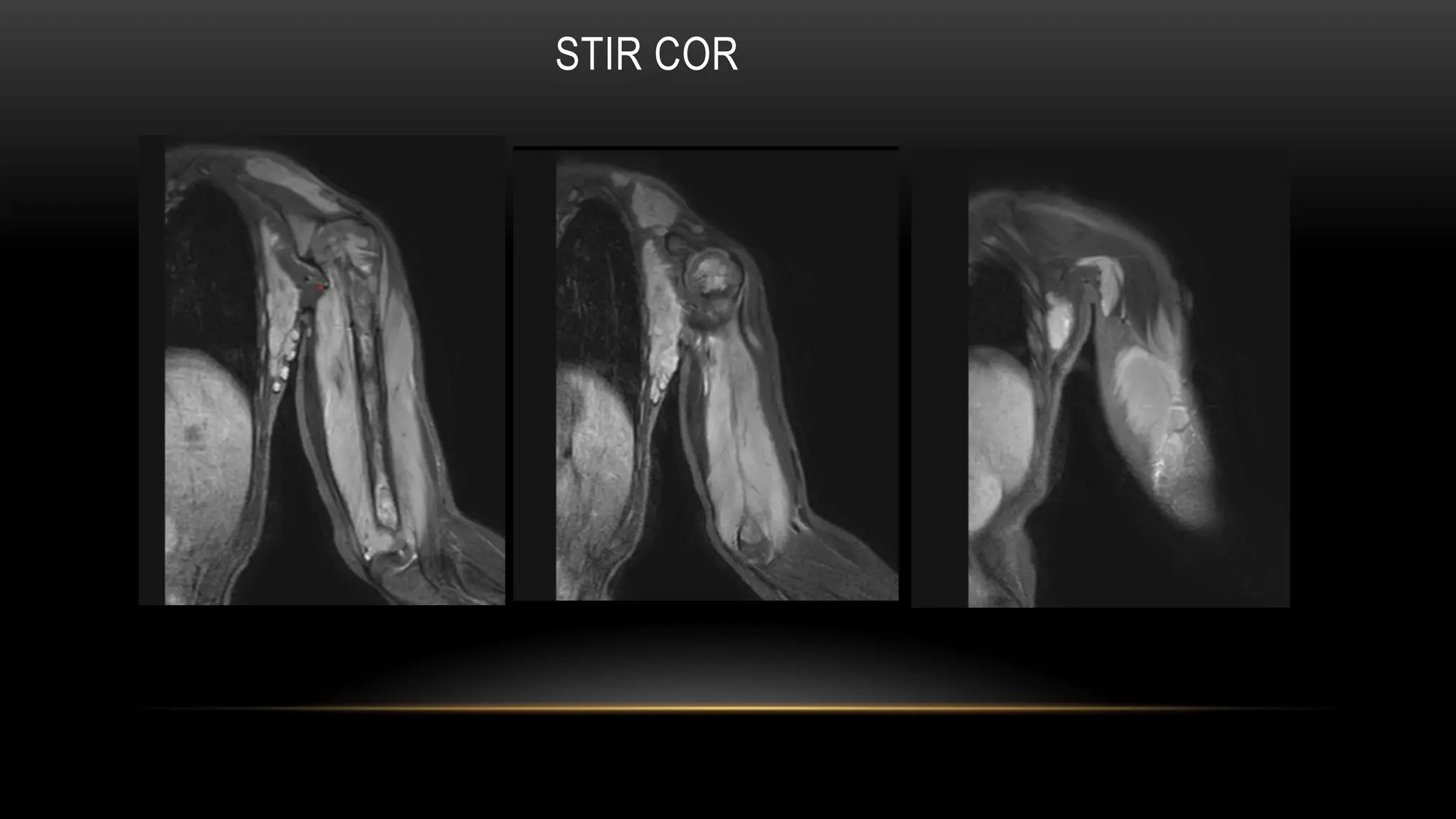 aggressive malignant neoplastic etiology like, Ewing’s sarcoma family vs other round cell tumor ...