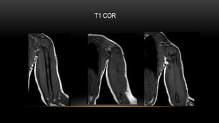 aggressive malignant neoplastic etiology like, Ewing’s sarcoma family vs other round cell tumor ...