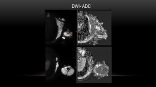 aggressive malignant neoplastic etiology like, Ewing’s sarcoma family vs other round cell tumor ...