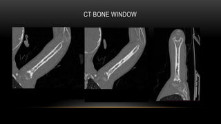 aggressive malignant neoplastic etiology like, Ewing’s sarcoma family vs other round cell tumor ...