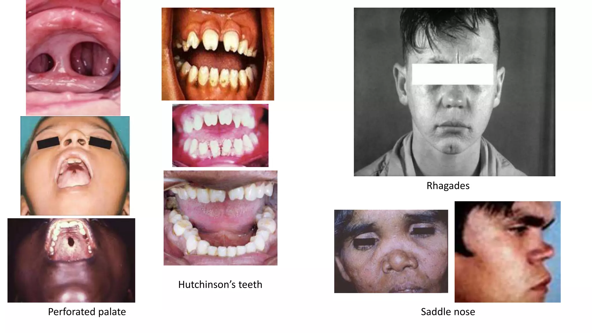 10th lecture syphilis | PPTX