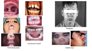10th lecture syphilis | PPTX