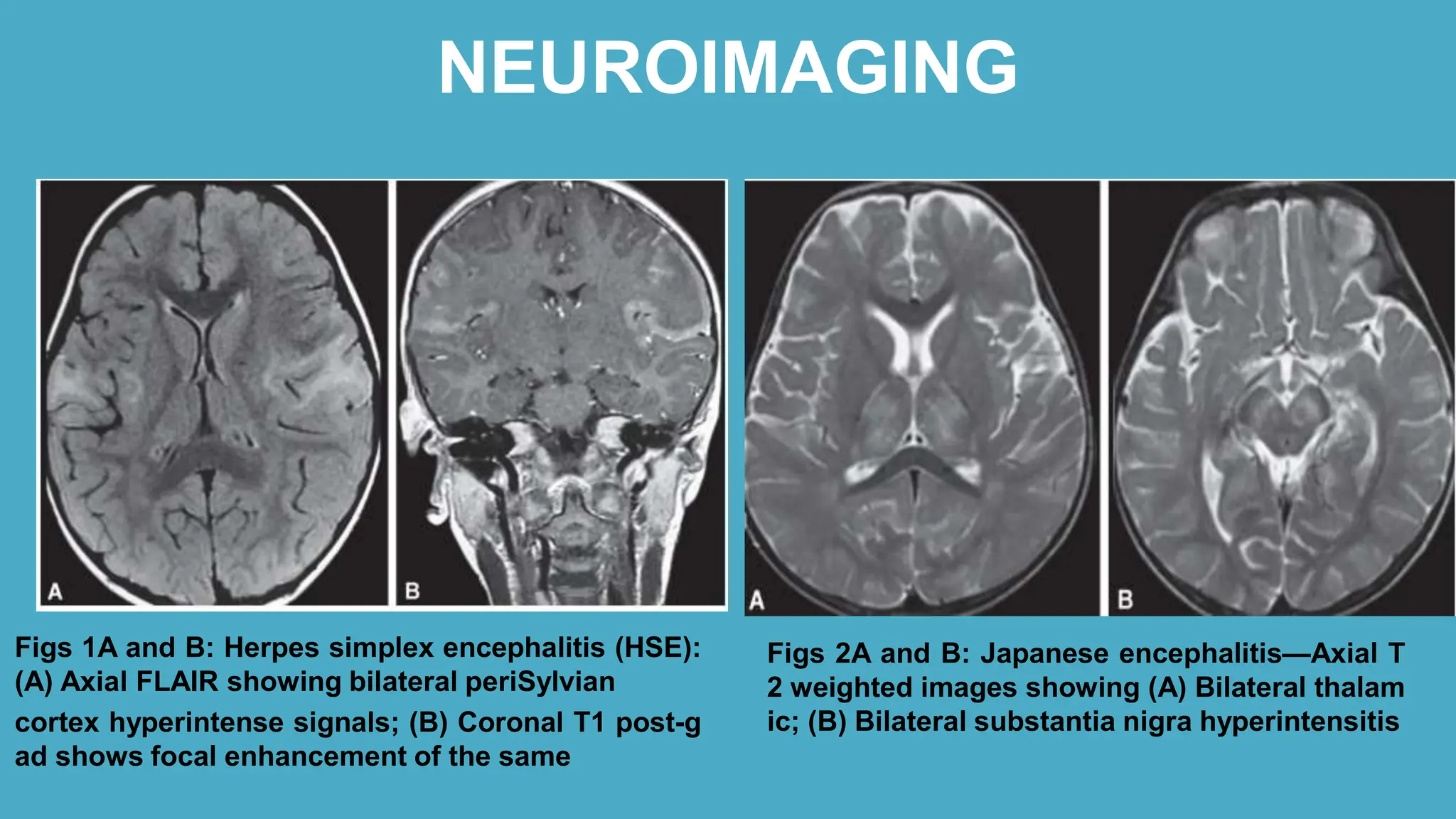 acute encephalitis syndrome | PPTX