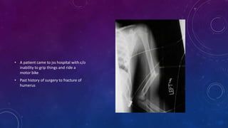 Damage Of Peripheral Nerve | PPTX