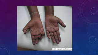 Damage Of Peripheral Nerve | PPTX