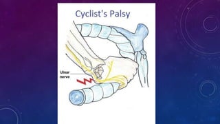 Damage Of Peripheral Nerve | PPTX