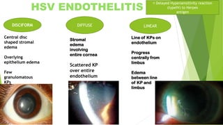 Viral Keratitis.pdf