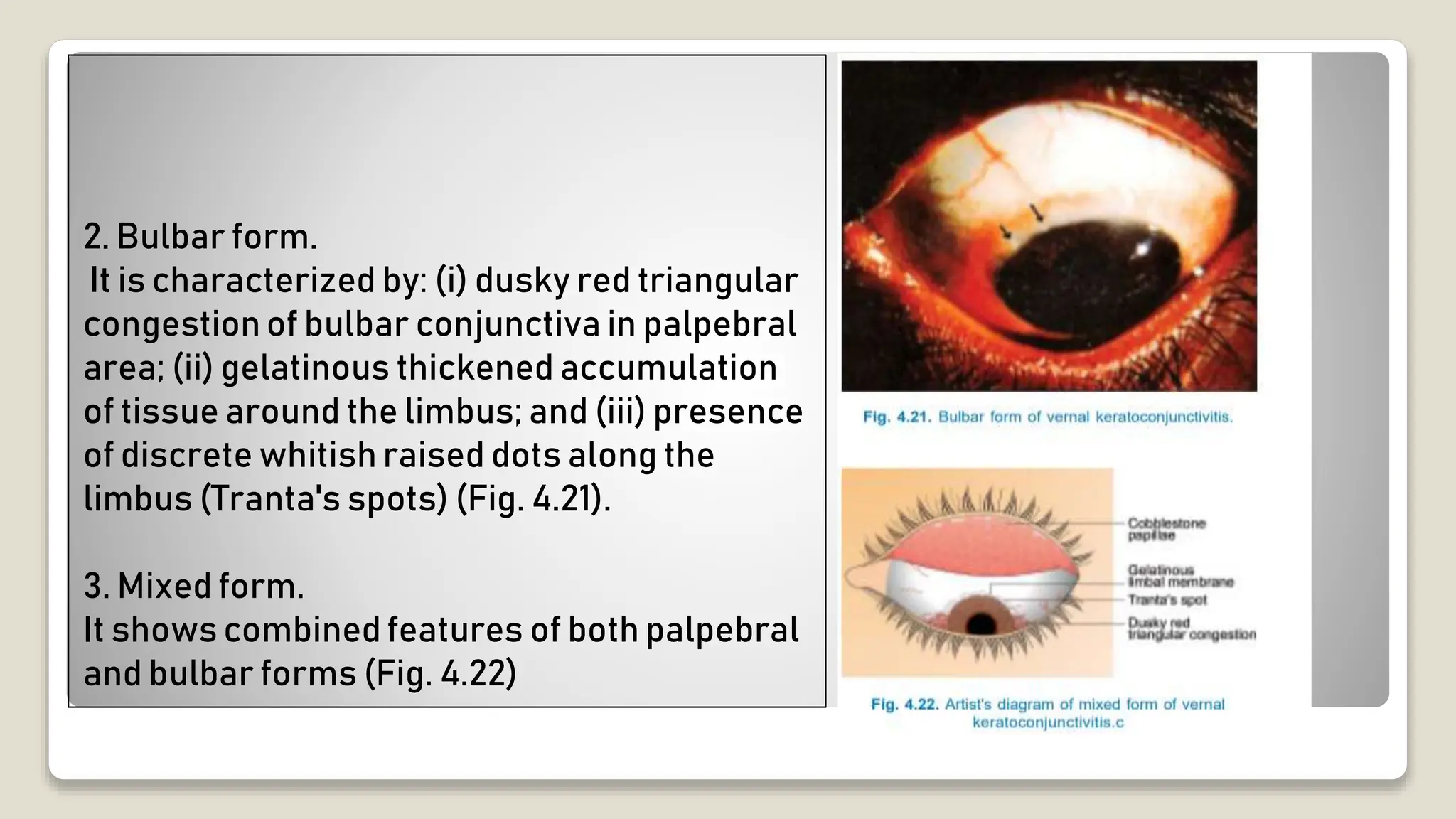 VKC by HARSHIT VERMA.pptx conjunctivitis | PPTX