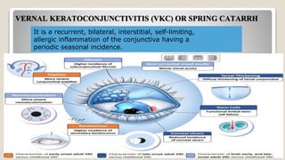 VKC by HARSHIT VERMA.pptx conjunctivitis | PPTX