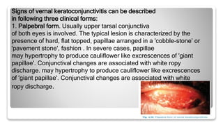 VKC by HARSHIT VERMA.pptx conjunctivitis | PPTX
