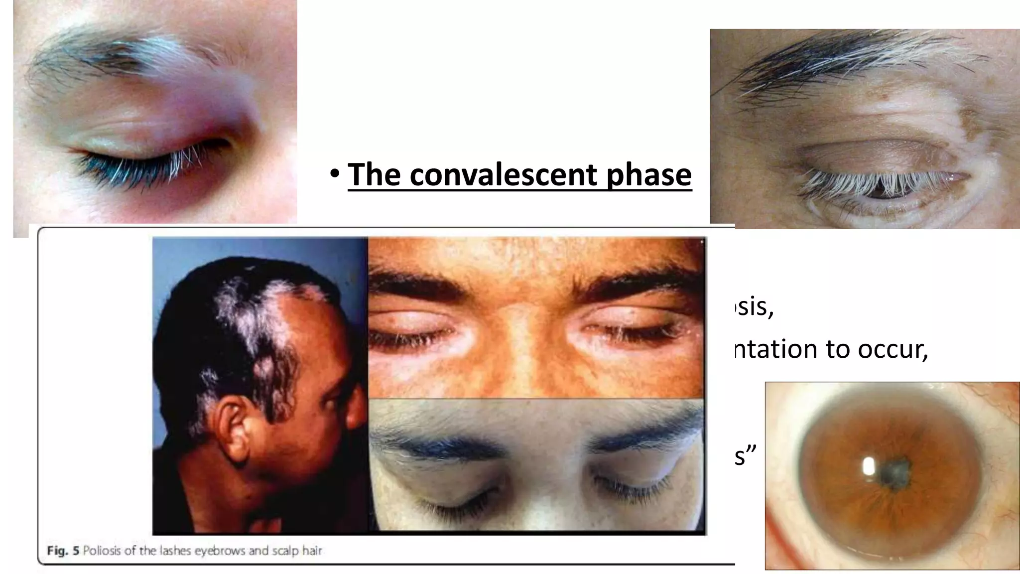 Vogt-Koyanagi-Harada (VKH) syndrome | PPTX