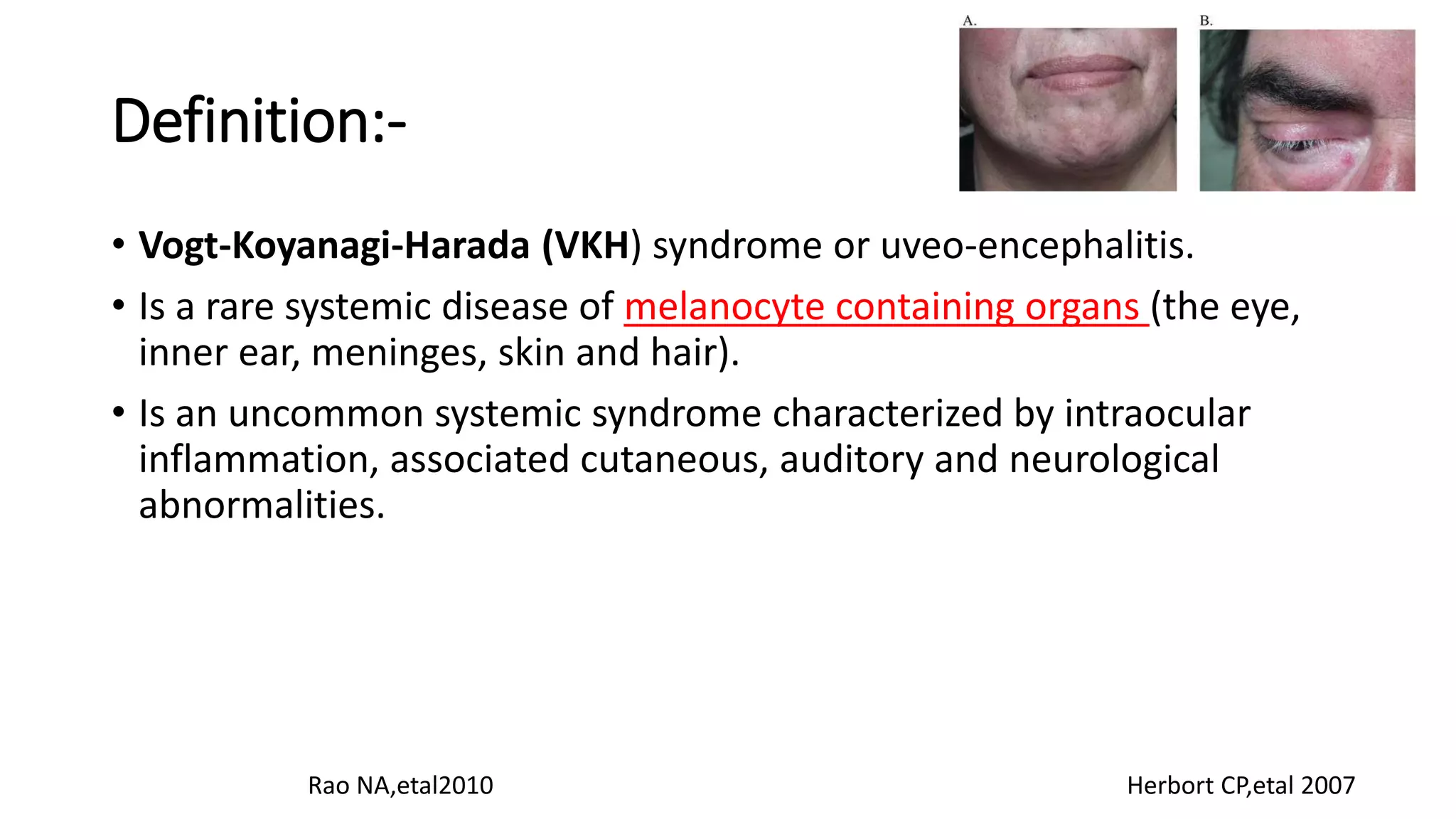 Vogt-Koyanagi-Harada (VKH) syndrome | PPTX