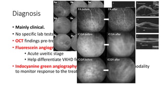 Vogt-Koyanagi-Harada (VKH) syndrome | PPTX