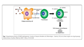 Vogt-Koyanagi-Harada (VKH) syndrome | PPTX