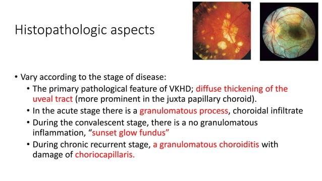 Vogt-Koyanagi-Harada (VKH) syndrome | PPTX | Eye and Vision Conditions ...