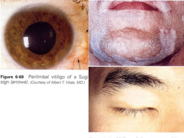 Uveitis in Behcet disease and VKH