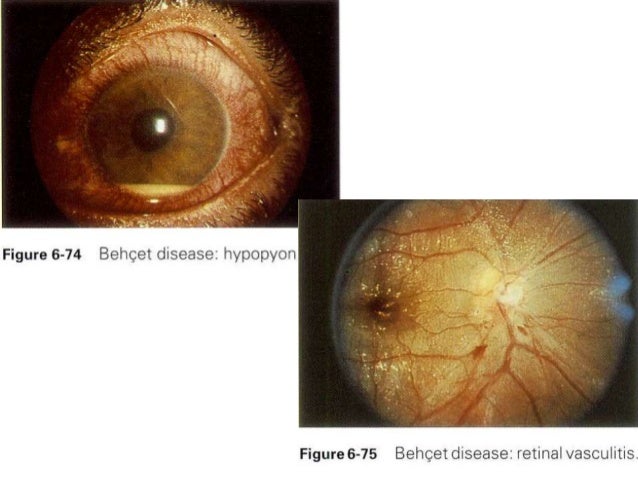 Uveitis in Behcet disease and VKH