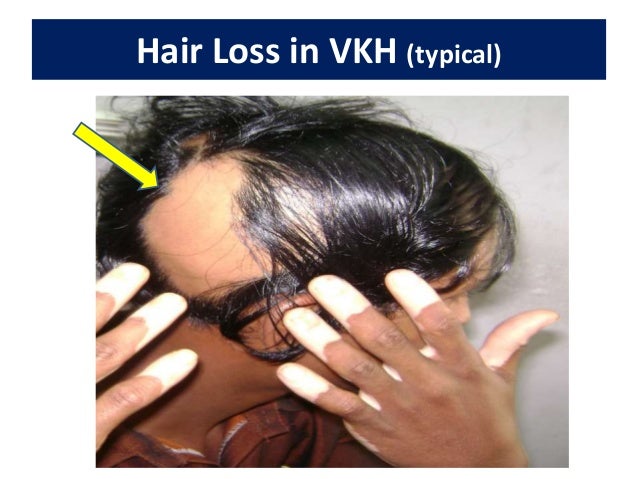 Vogt Koyanagi Harada Syndrome (VKH)