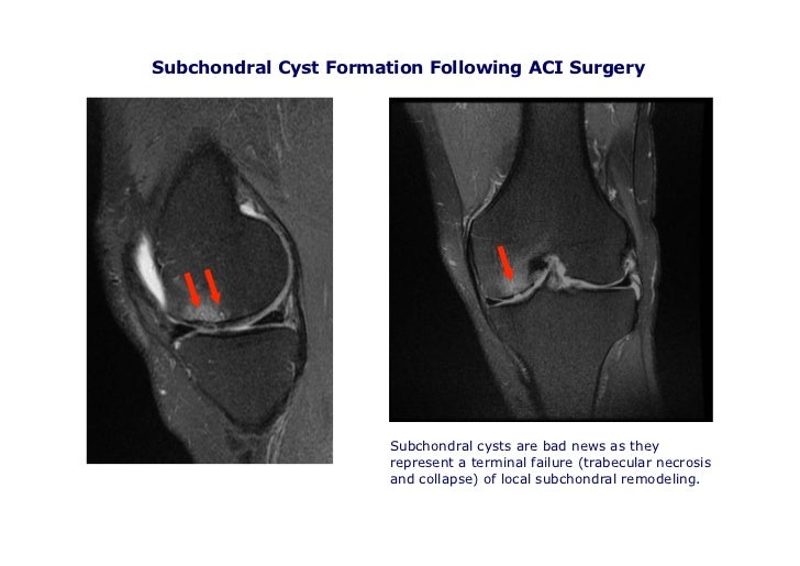 Subchondral Events and Treatment
