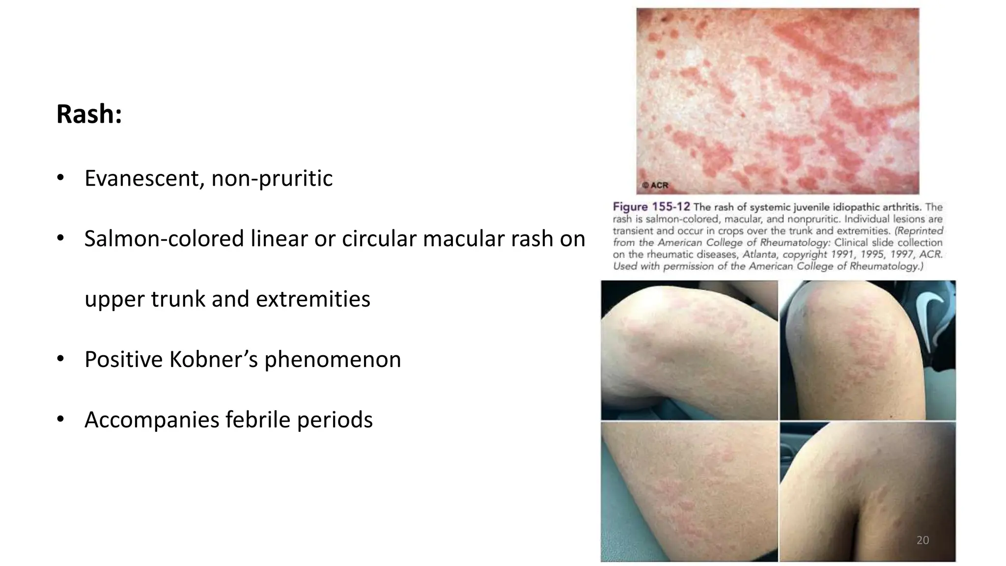 Juvenile Idiopathic Arthritis / JIA.pptx