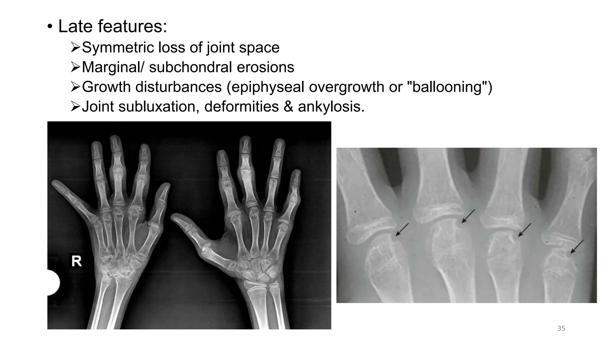 Juvenile Idiopathic Arthritis / JIA.pptx