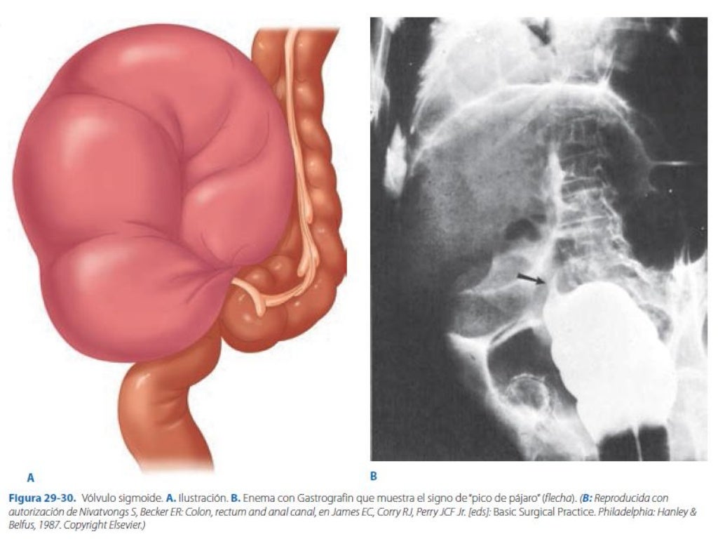 1.Vólvulo intestinal