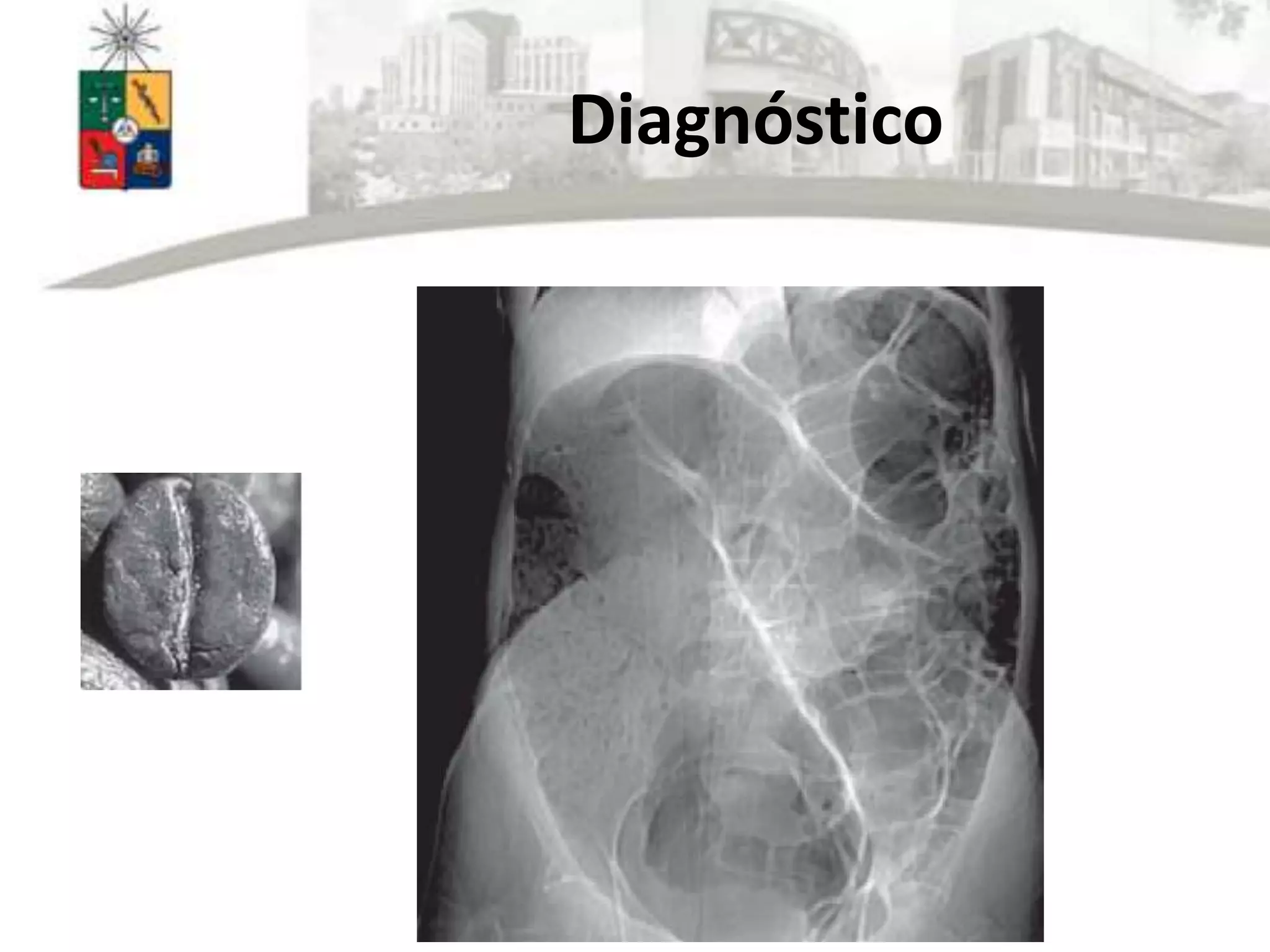 Vólvulo sigmoides y megacolon | PPTX