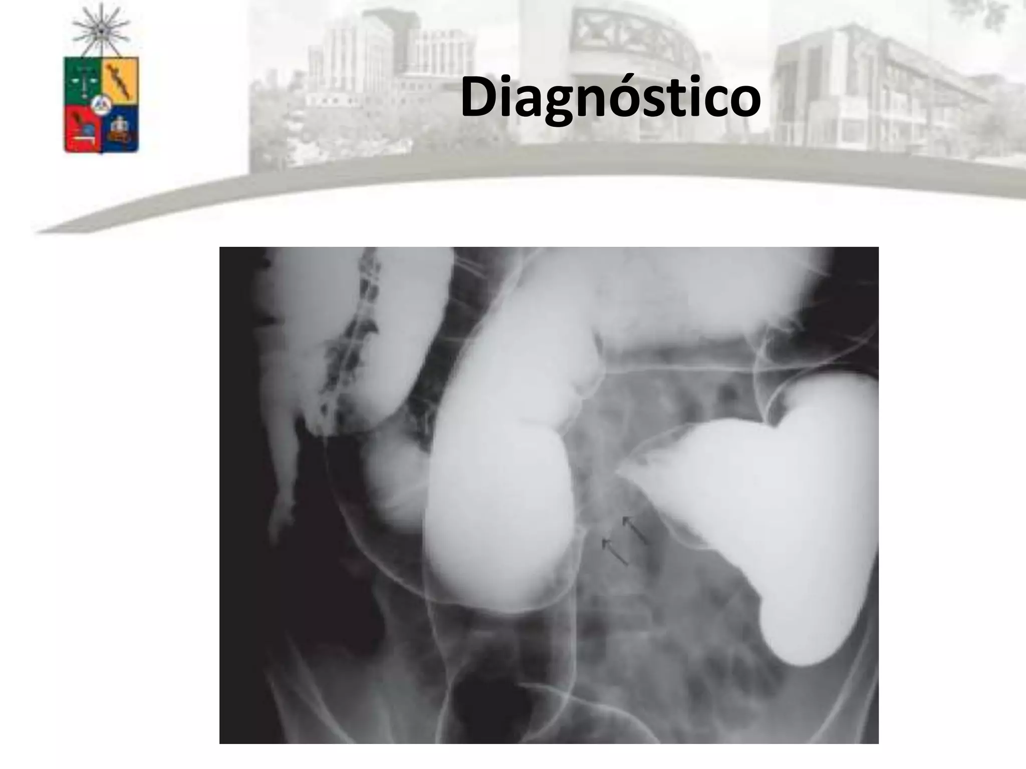 Vólvulo sigmoides y megacolon | PPTX