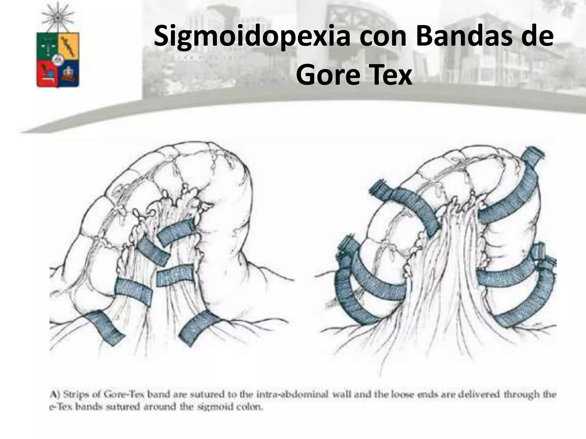 Vólvulo sigmoides y megacolon | PPTX