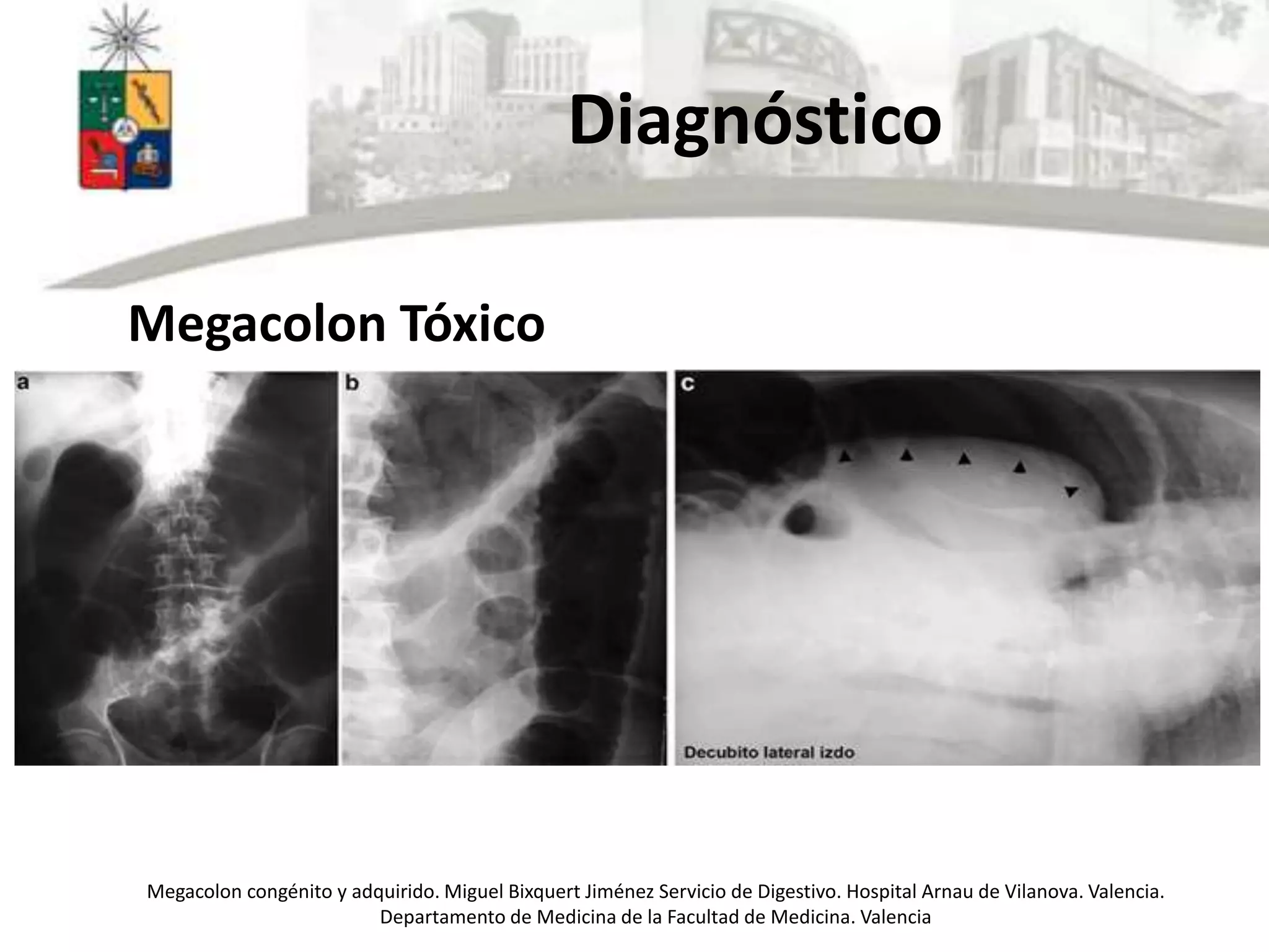Vólvulo sigmoides y megacolon | PPTX