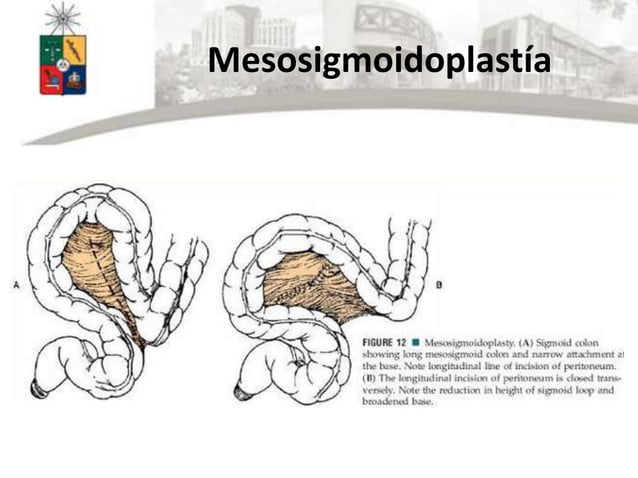 Vólvulo sigmoides y megacolon | PPTX