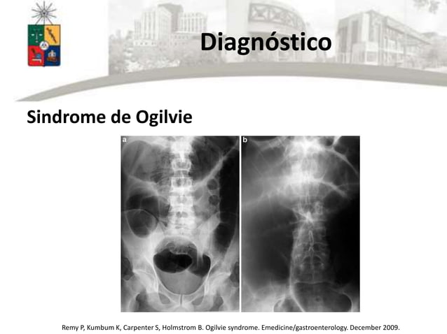 Vólvulo sigmoides y megacolon | PPTX
