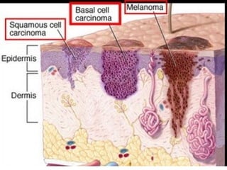 Locally malignant tumor | PPT
