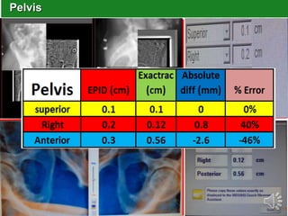 Vmat technique for Breast, Head and Neck, Brain and Craniospinal ...