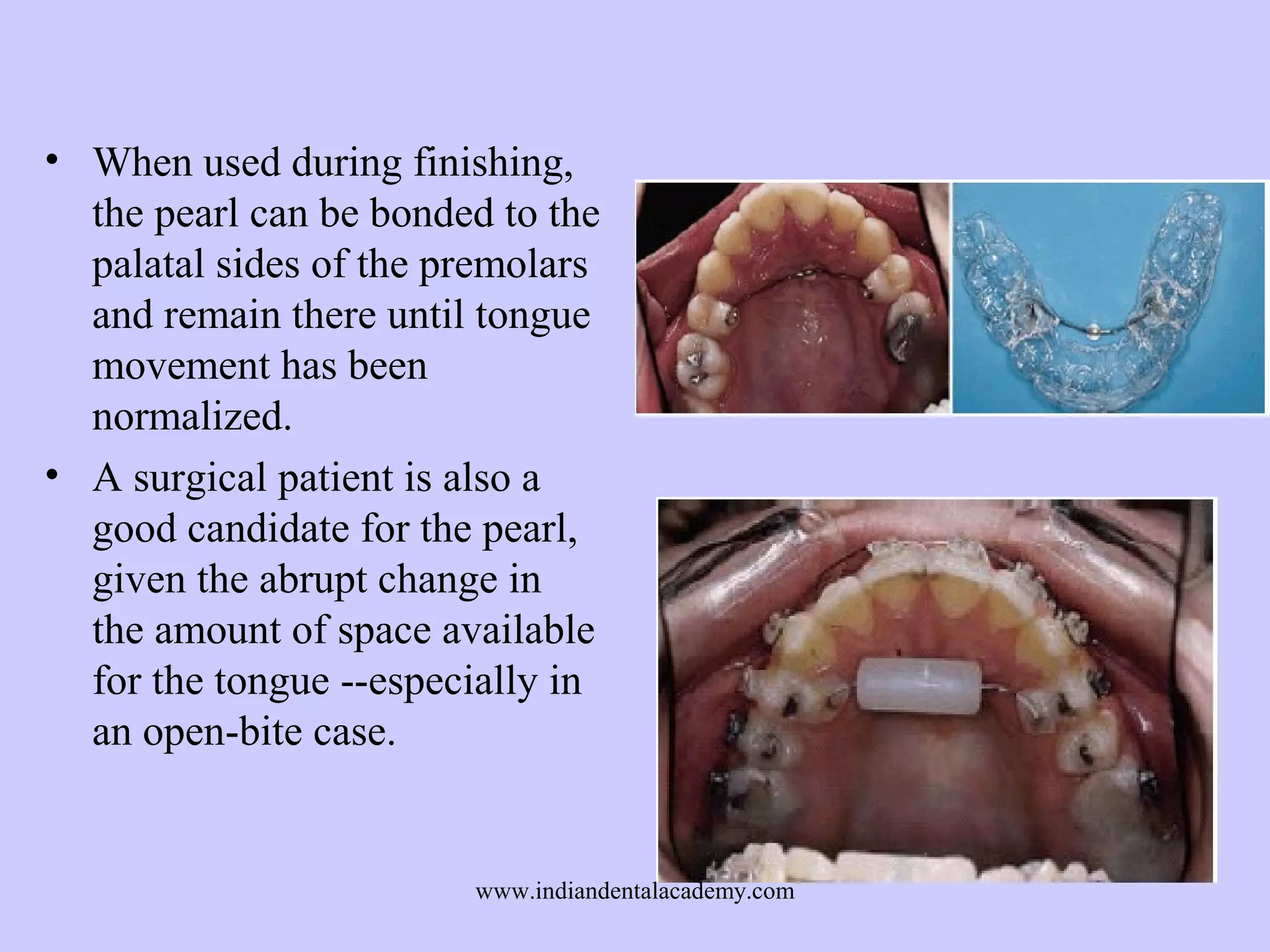 Vertical maxillary excess | PPT