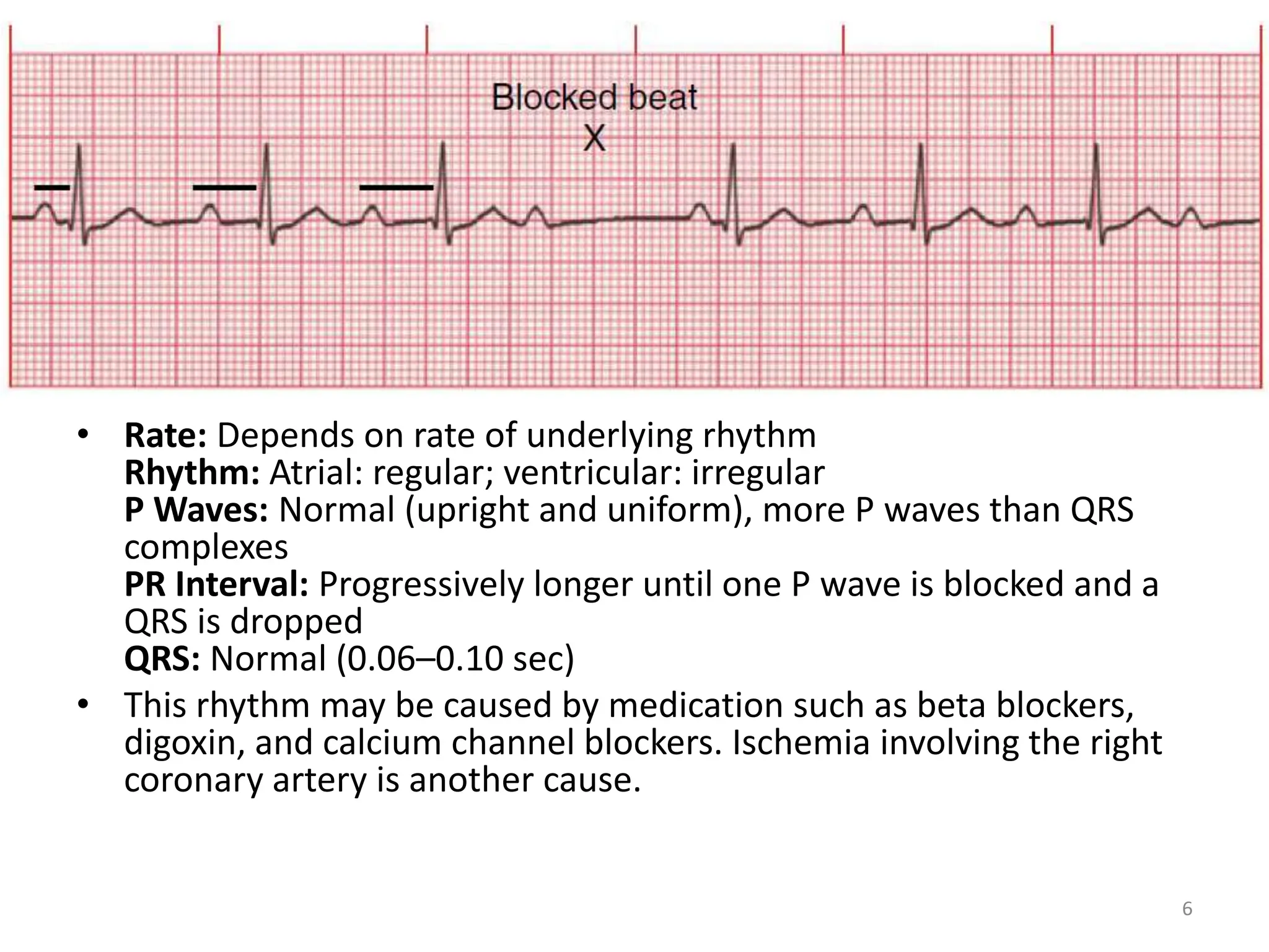 Heart blocks slide for pharmacy and study | PPT