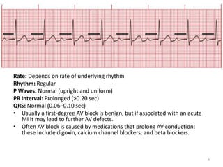 Heart blocks slide for pharmacy and study | PPT