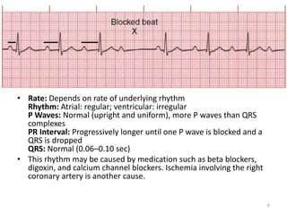 Heart blocks slide for pharmacy and study | PPT