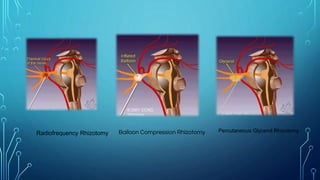 Trigeminal nerve.pptx