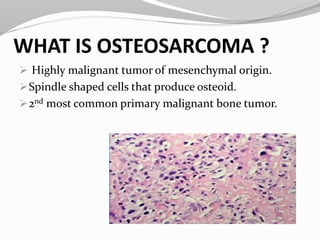 osteosarcoma | PPTX