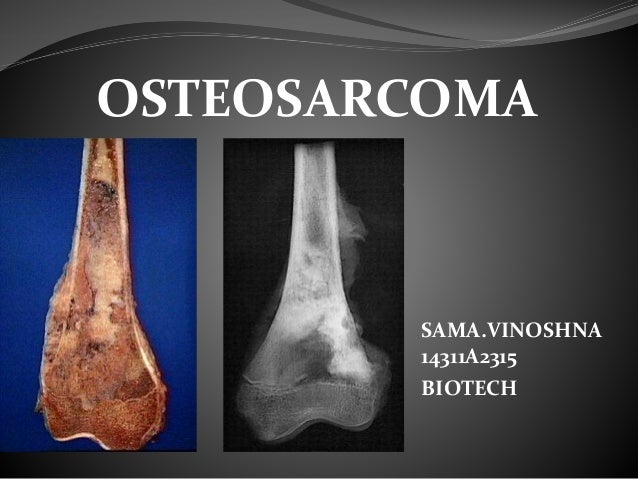osteosarcoma