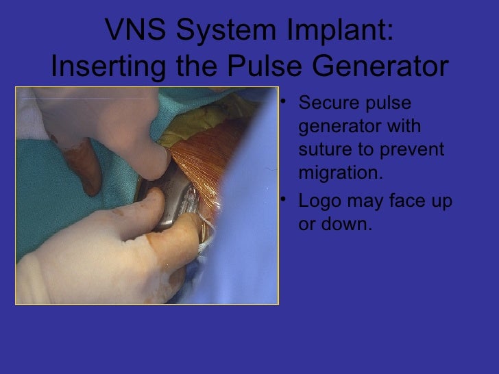 Vns Therapy™ System For Weikong For Print