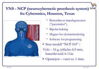 VNS treatment of epilepsy | PPS