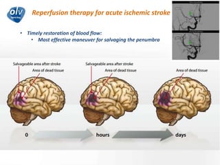 Stroke & thrombectomy - Dr. Jo Caekebeke | PPTX
