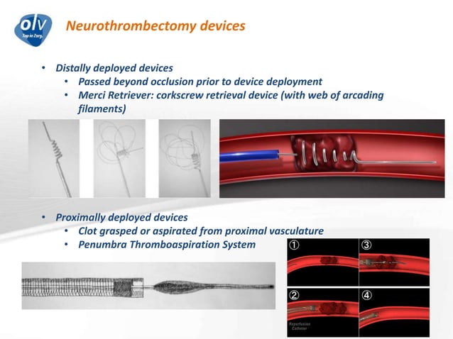 Stroke & thrombectomy - Dr. Jo Caekebeke | PPTX | Blood Disorders ...
